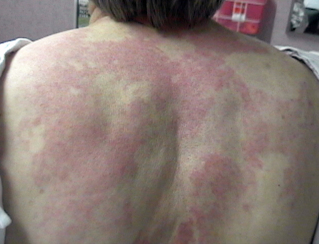 Hive Treatment Chelmsford North Andover Ma And Nashua Nh Allergy